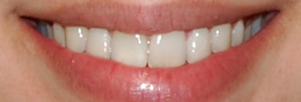 Smile Gallery - Dawson Dental