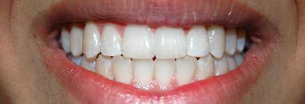 Smile Gallery - Dawson Dental