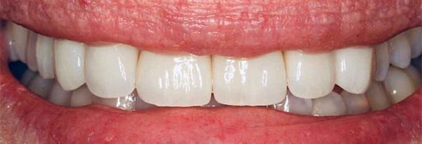 Smile Gallery - Dawson Dental