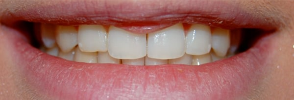 Smile Gallery - Dawson Dental