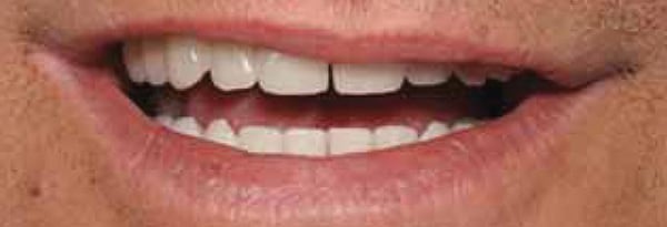 Dental Implants | Dentists In Aurora, ON | Dawson Dental